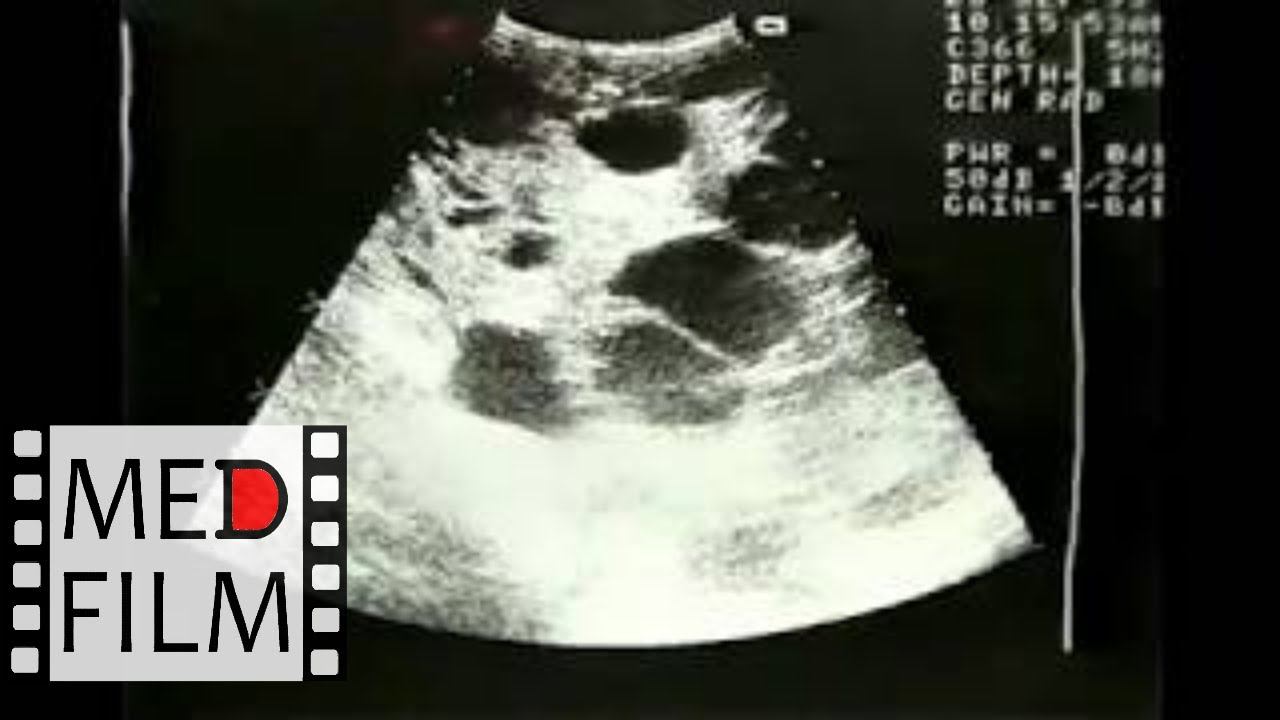 Поликистоз печени © polycystic liver