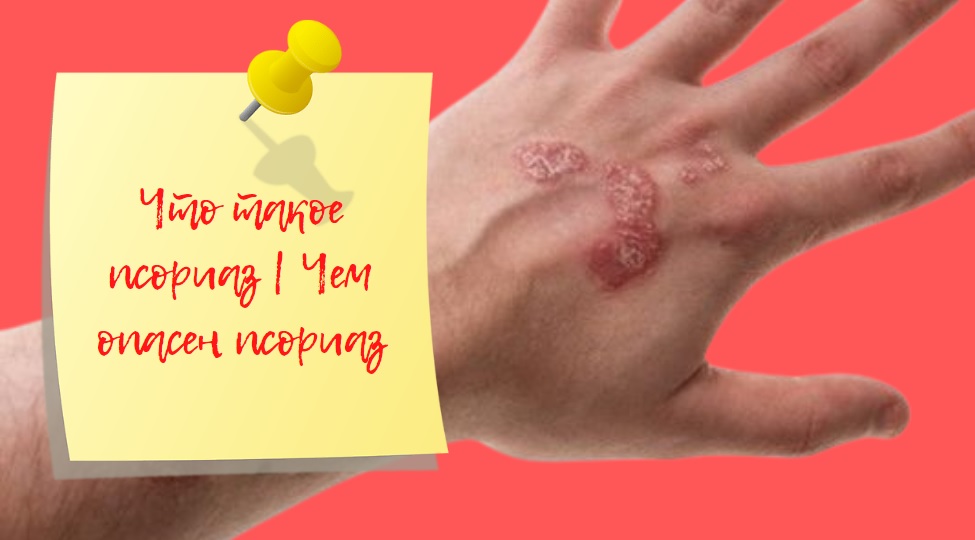 Что такое псориаз | Чем опасен псориаз