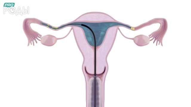 Гистеросальпингография