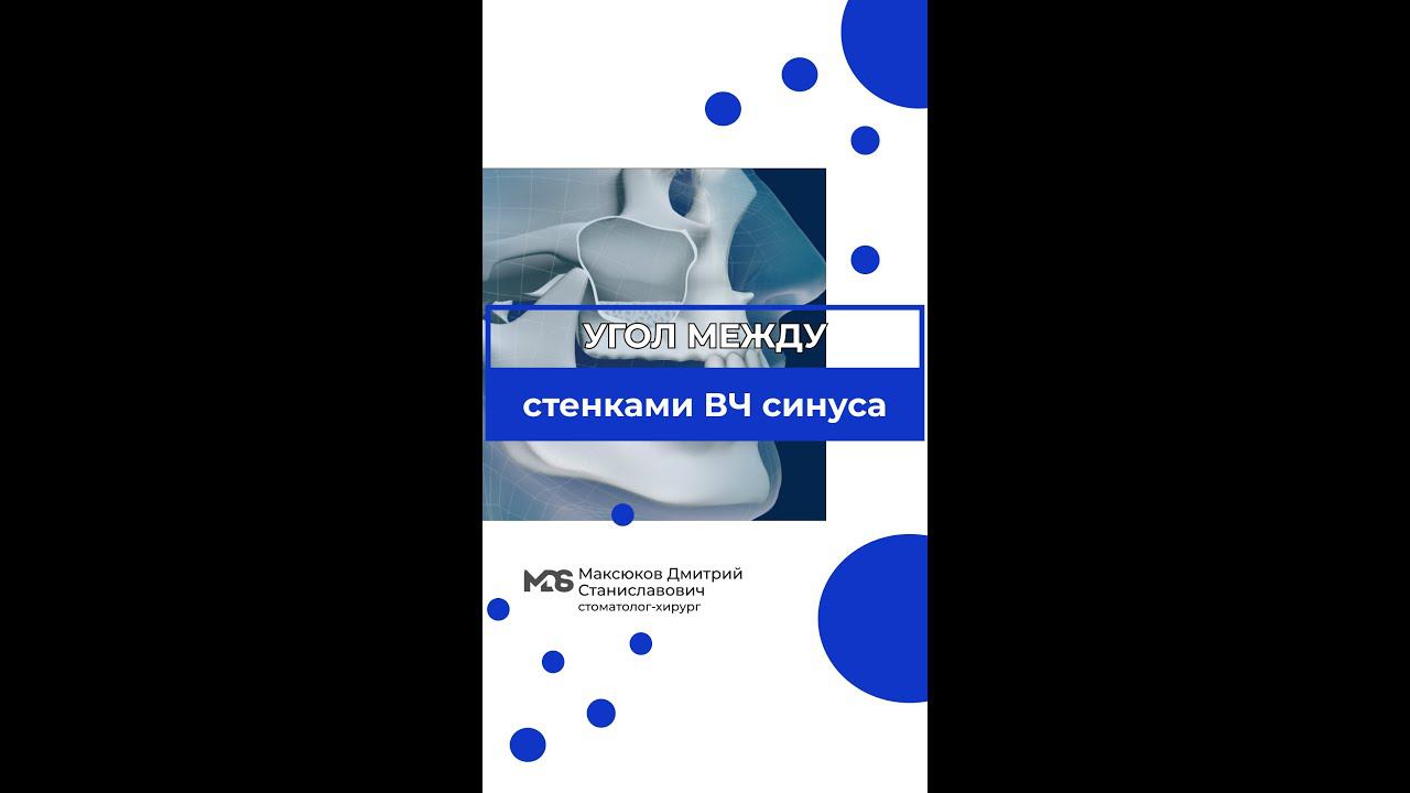 Взаиоморасположение латеральной и медиальной стенок ВЧ синуса