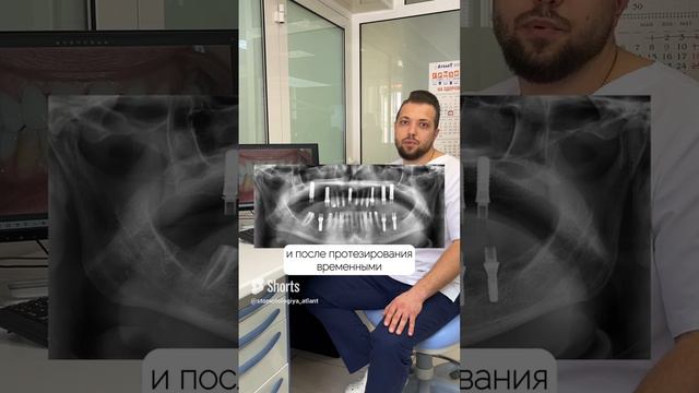 Замена старых пломб на виниры и коронки #зубы #виниры #коронки #пломбы