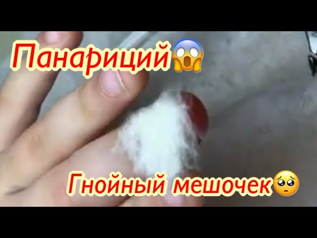 ПАНАРИЦИЙ  ? • Мальчику 7 лет
