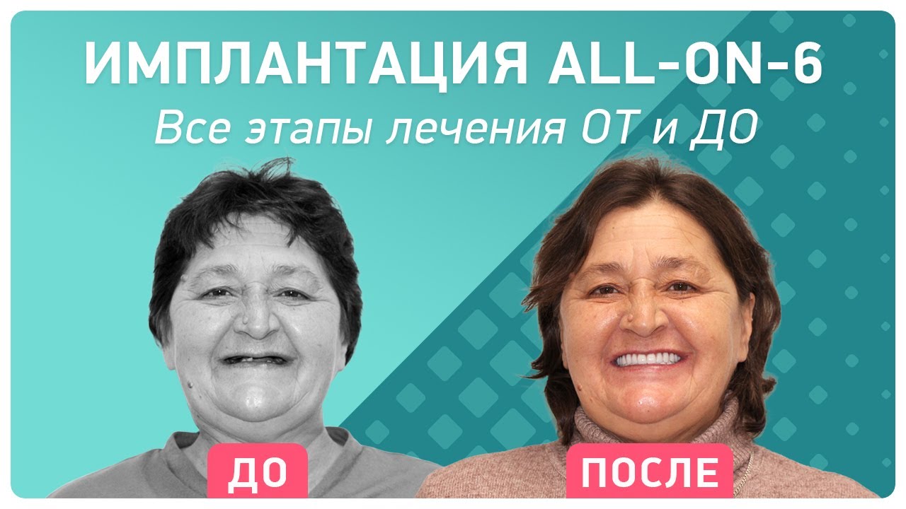 Все этапы all-on-6: новые зубы за 3 дня