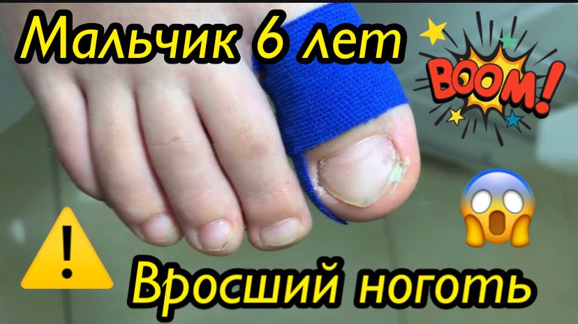 Мальчик 6 лет⚠️?❗️ • Вросший ноготь??⚠️?