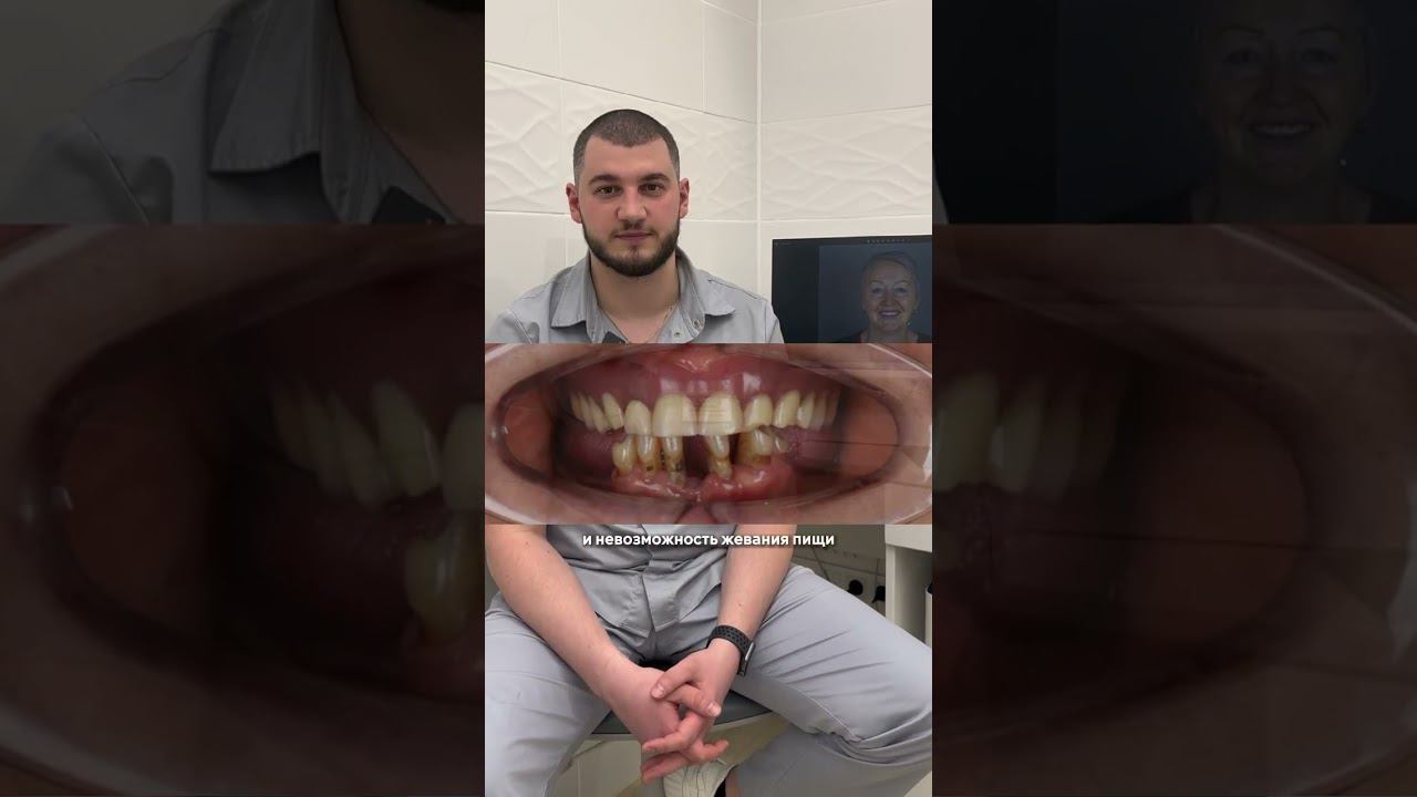 Имплантации и протезирование по методике «Все зубы на 4» #всена4 #стоматология