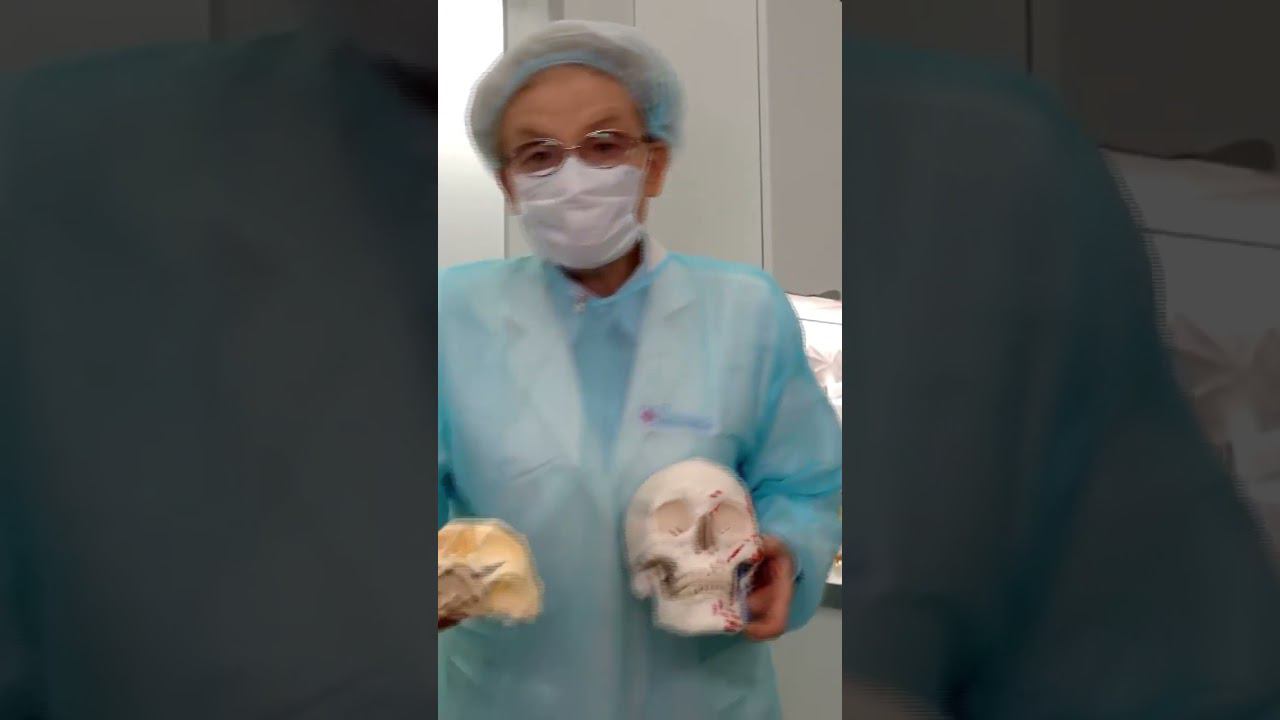 Вся челюсть на 4 имплантах Зигома (Zygoma) в Санкт-Петербурге