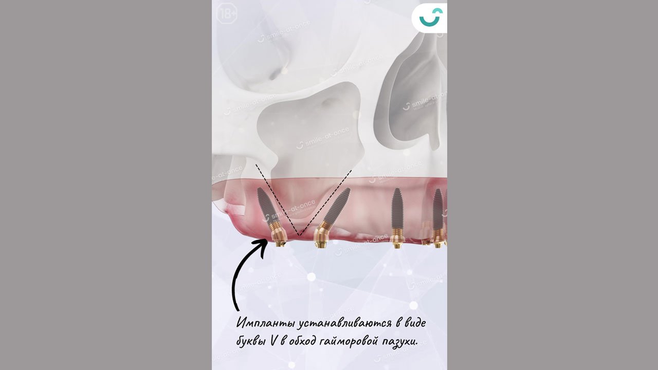 Имплантация зубов V-II-V без синус-лифтинга. Почему только пять врачей владеют методом?