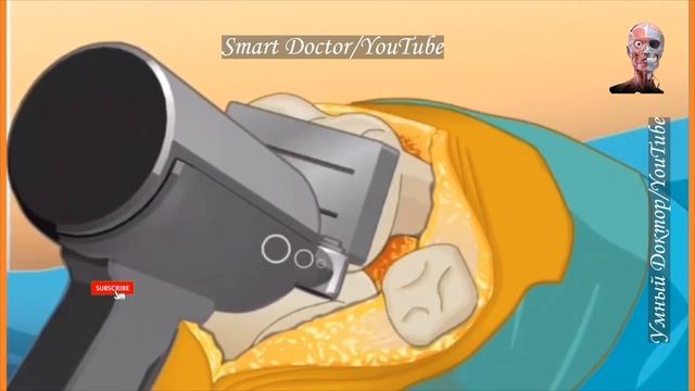 Knee Replacement Surgery ????. knee arthroplasty. ?.mp4