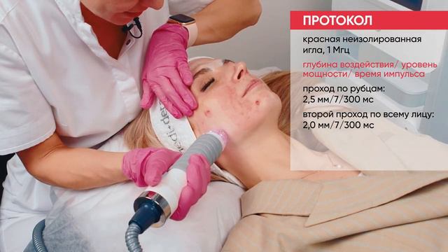 RF-лифтинг VIVACE. Кейс: Зинаида, 30 лет, постакне, воспалительные элементы, расширенные поры