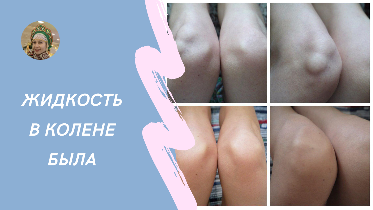 Лучший способ избавиться от жидкости в коленном суставе
