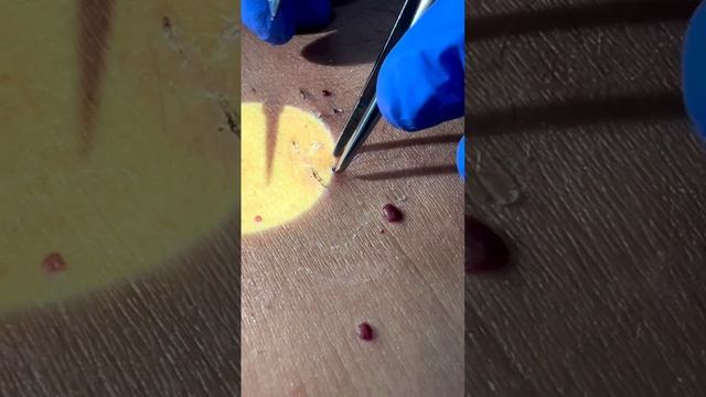 ☀️ Липоматоз. Снятие швов после удаления множественных липом на животе