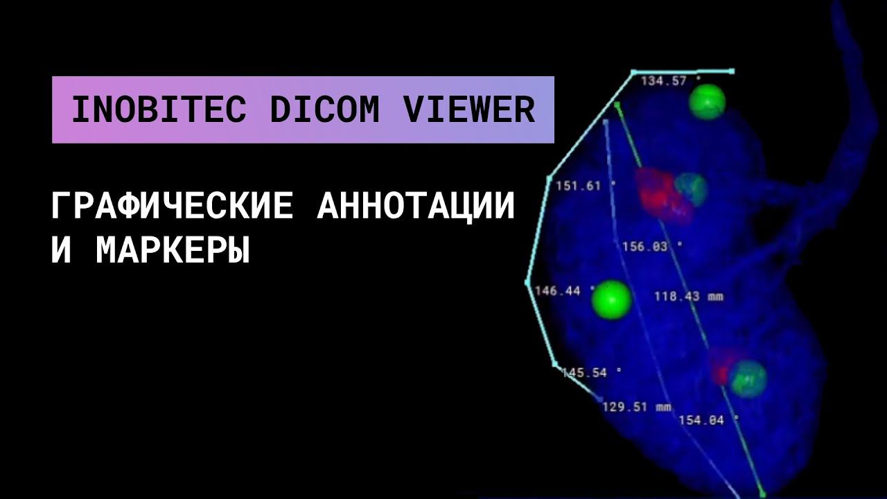 Графические аннотации и маркеры в Inobitec DICOM Viewer