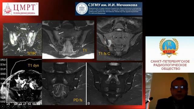 МР-диагностика сакроилеита