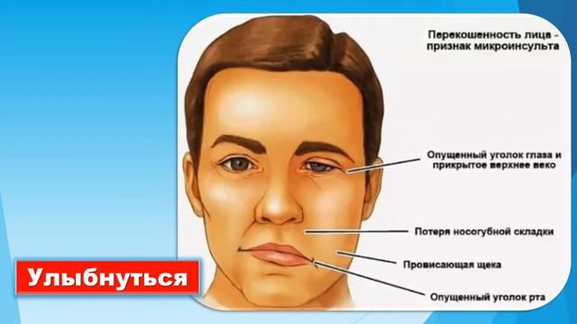 Берегите близких от инсульта
