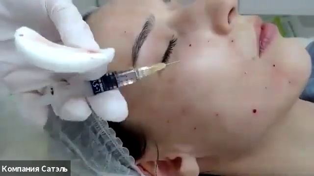 Демонстрация методики или препарата биоревитализации