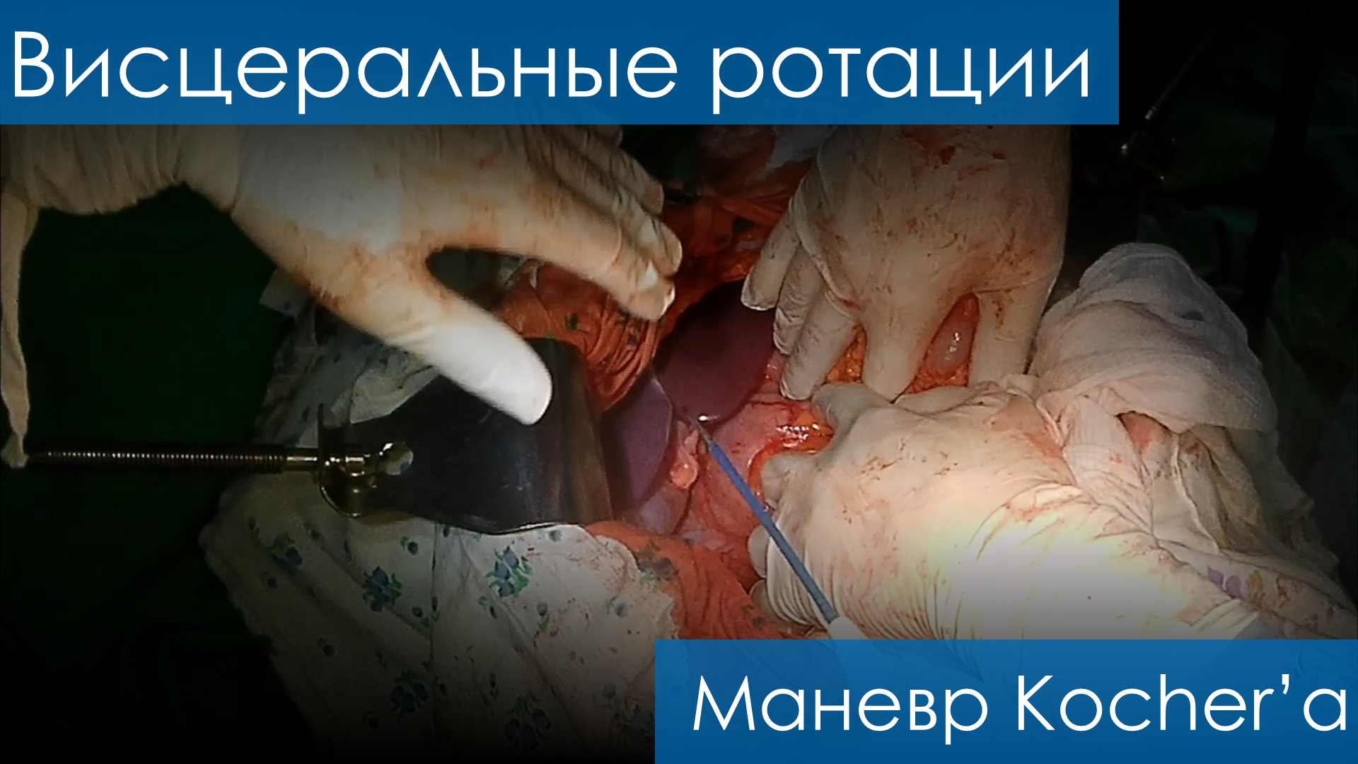 Хирургические доступы: Маневр Кохера/The Kocher Maneuver