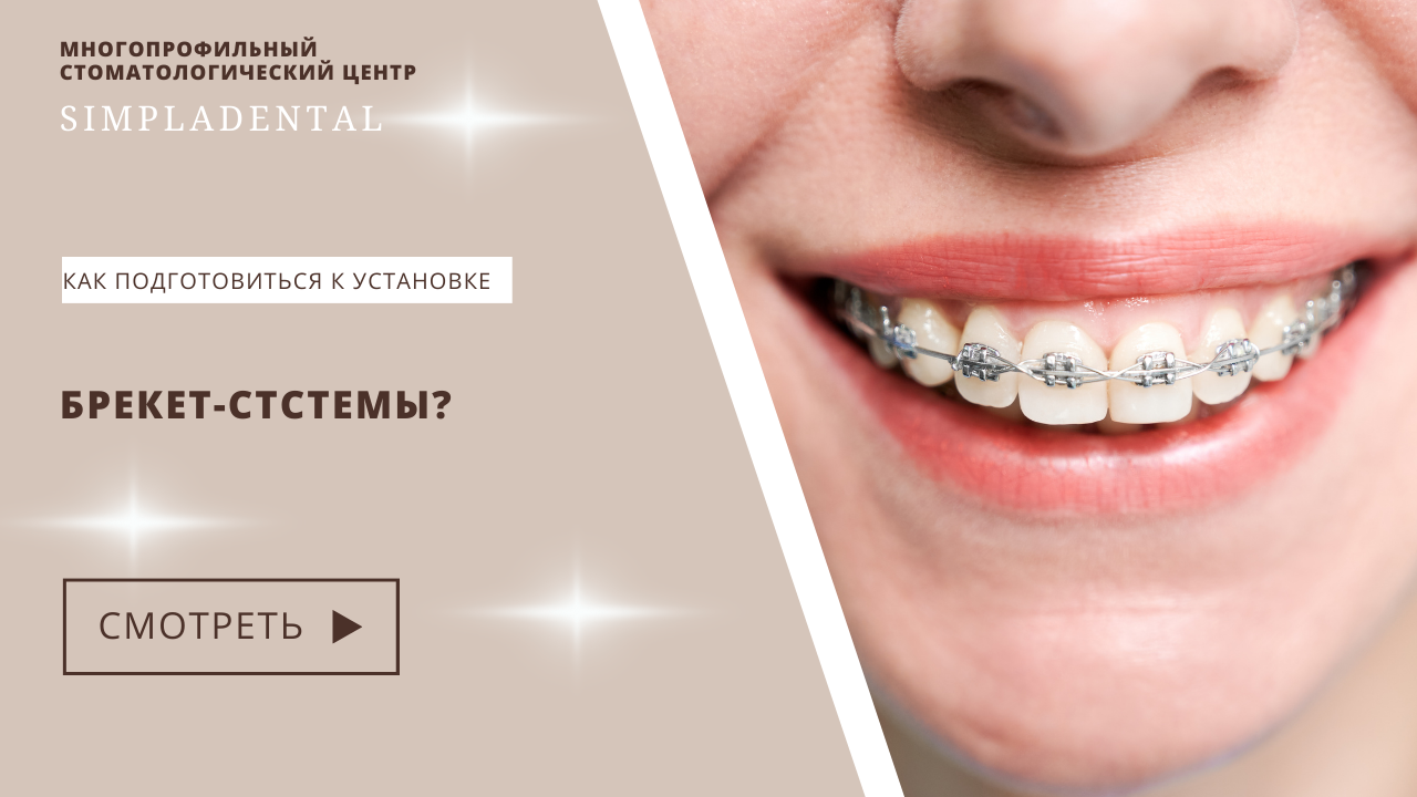 Как подготовиться к установке брекет-системы?