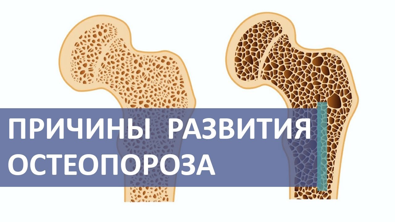 ? Что такое остеопороз, как он проявляется, каковы факторы развития. Что такое остеопороз. 12+