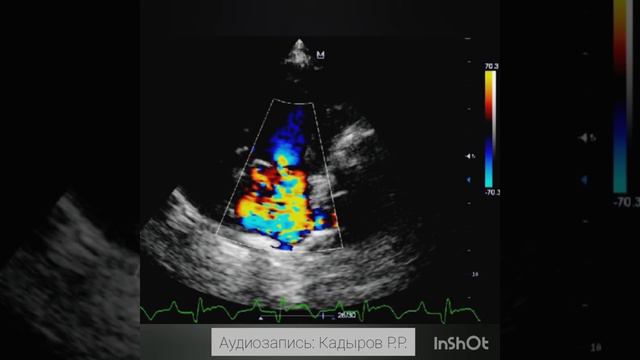 Систолический шум при недостаточности митрального клапана у собаки