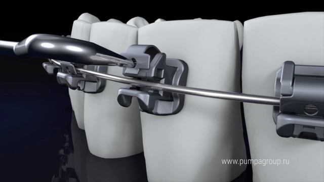 BioQuick — замена клипсы