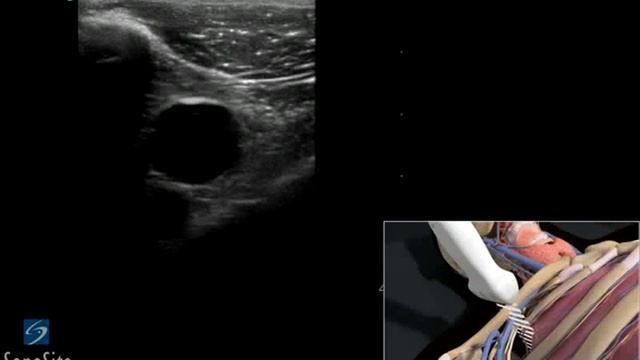 Катетеризация подключичной вены