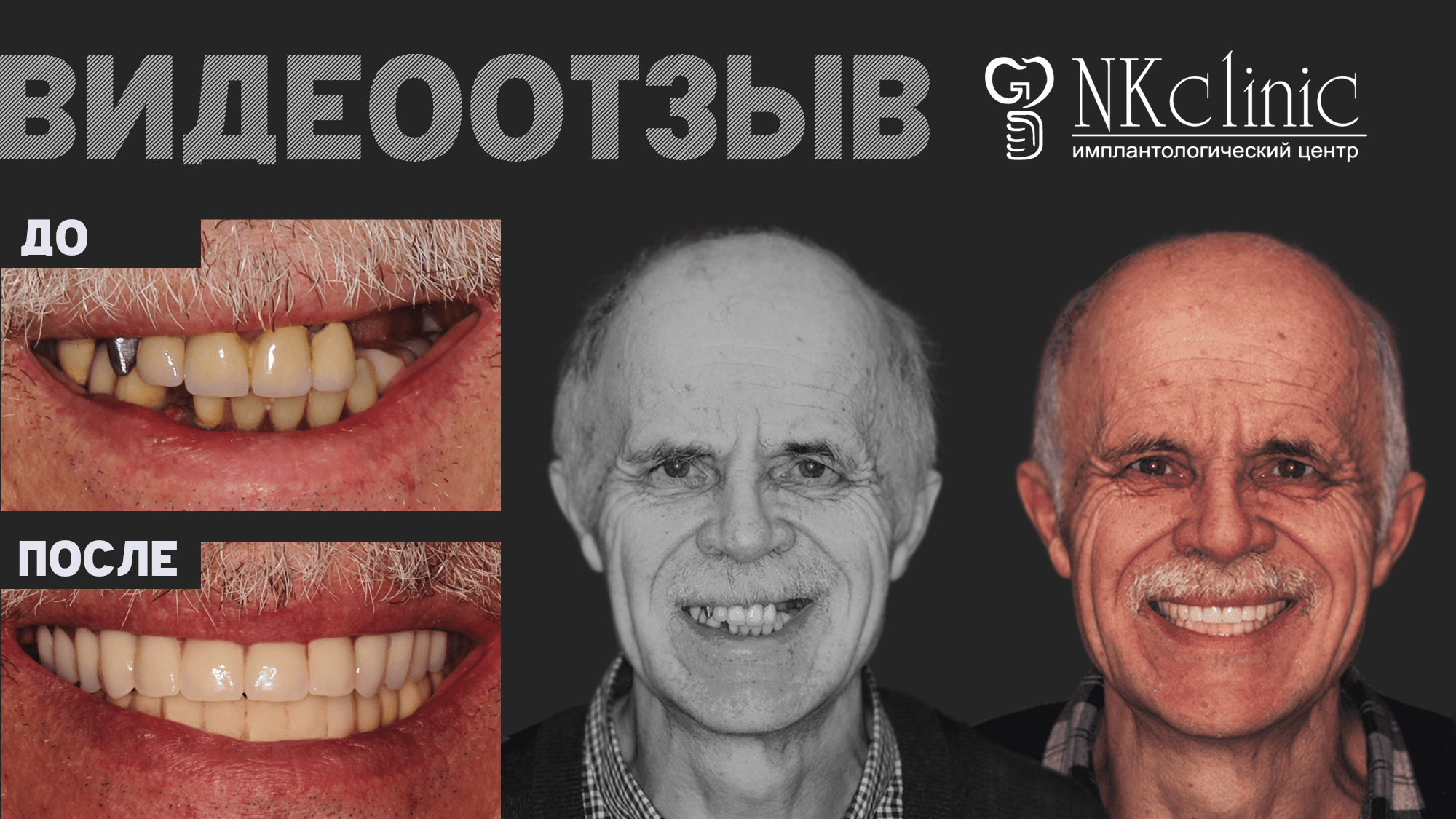 NKclinic - отзывы пациентов. Имплантация All on 4 и All on 8, реальные впечатления после операции.