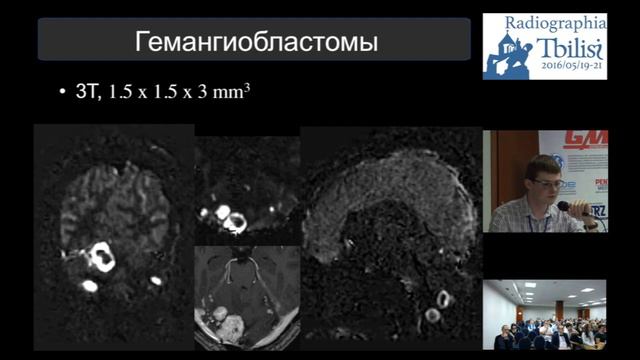 ASL-перфузия в онкологической практике