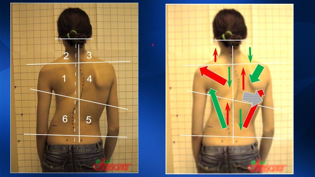 2.13. Массаж при нарушениях осанки и сколиозах | Медицинский массаж. Цикл 2