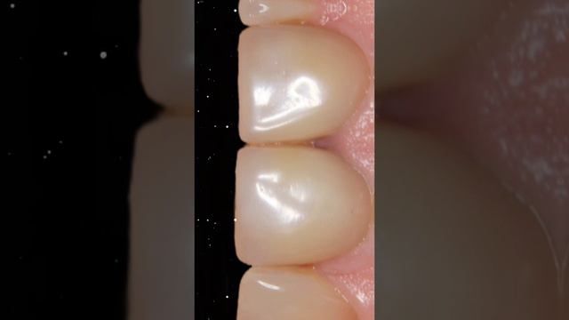 Тотальное преображение улыбки! #зубы #улыбка