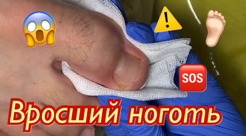 Вросший ноготь⚠️?❗️??