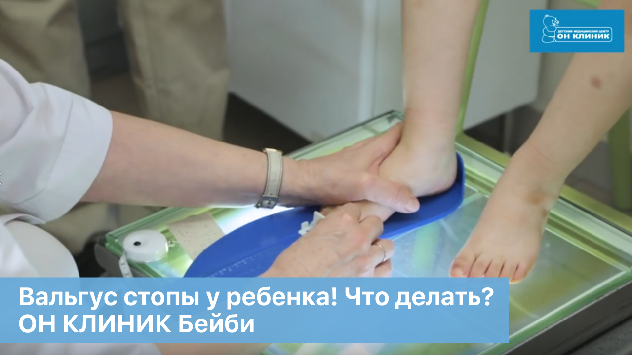 Вальгус стопы у ребенка! Что делать? ОН КЛИНИК Бейби.