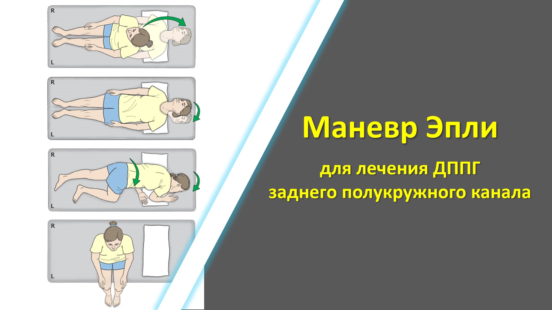 Маневр Эпли при ДППГ заднего полукружного канала | ДППГ