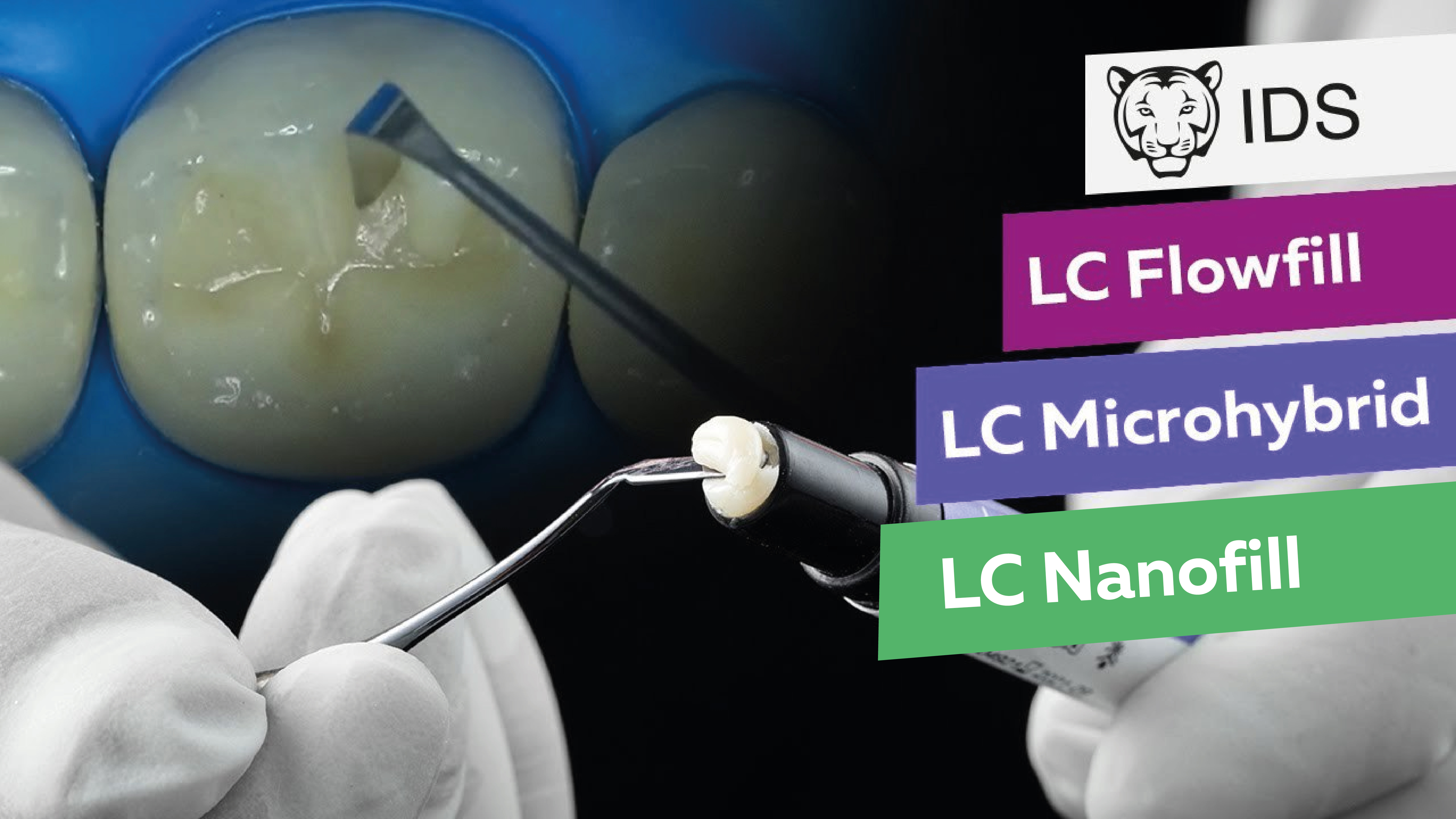 Композиты IDS | Реставрация 6 верхнего зуба