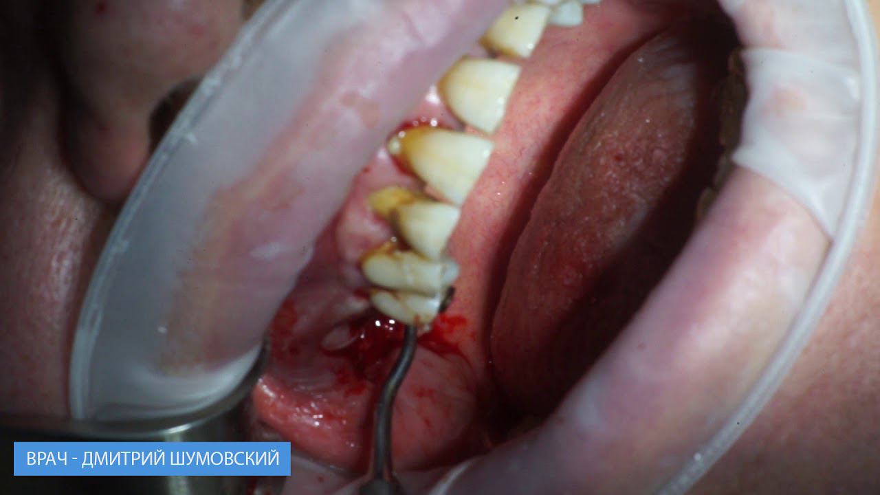 OneQ-SL. Одномоментная имплантация в позициях 15 и 17 + закрытый синус-лифтинг.