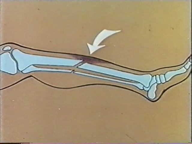 ОБЖ-НВП. Первая медицинская помощь. Первая медицинская помощь при переломах