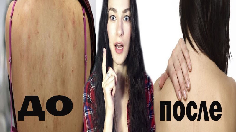 Как я избавилась от прыщей на спине и пятен от них _ АКНЕ - ПРОБЛЕМЫ ЛЕЧЕНИЕ