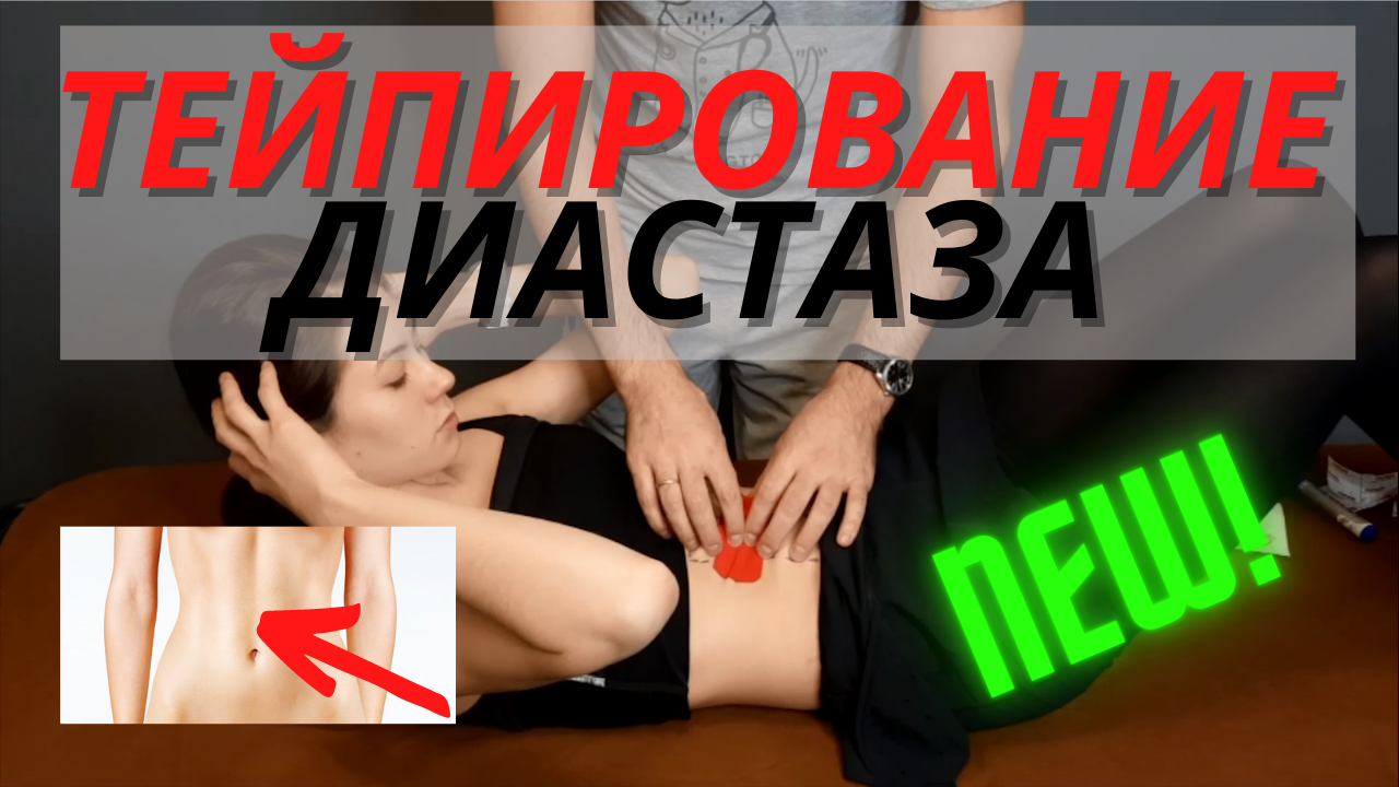 Тейпирование при диастазе. Лечебное кинезиотейпирование живота