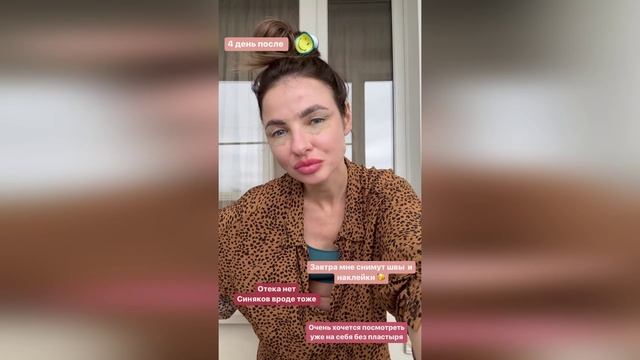 Четвертый день после блефаропластики