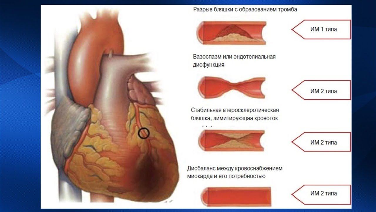 2.19. Массаж при стенокардии, ИБС, после инфаркта миокарда | Медицинский массаж. Цикл 2