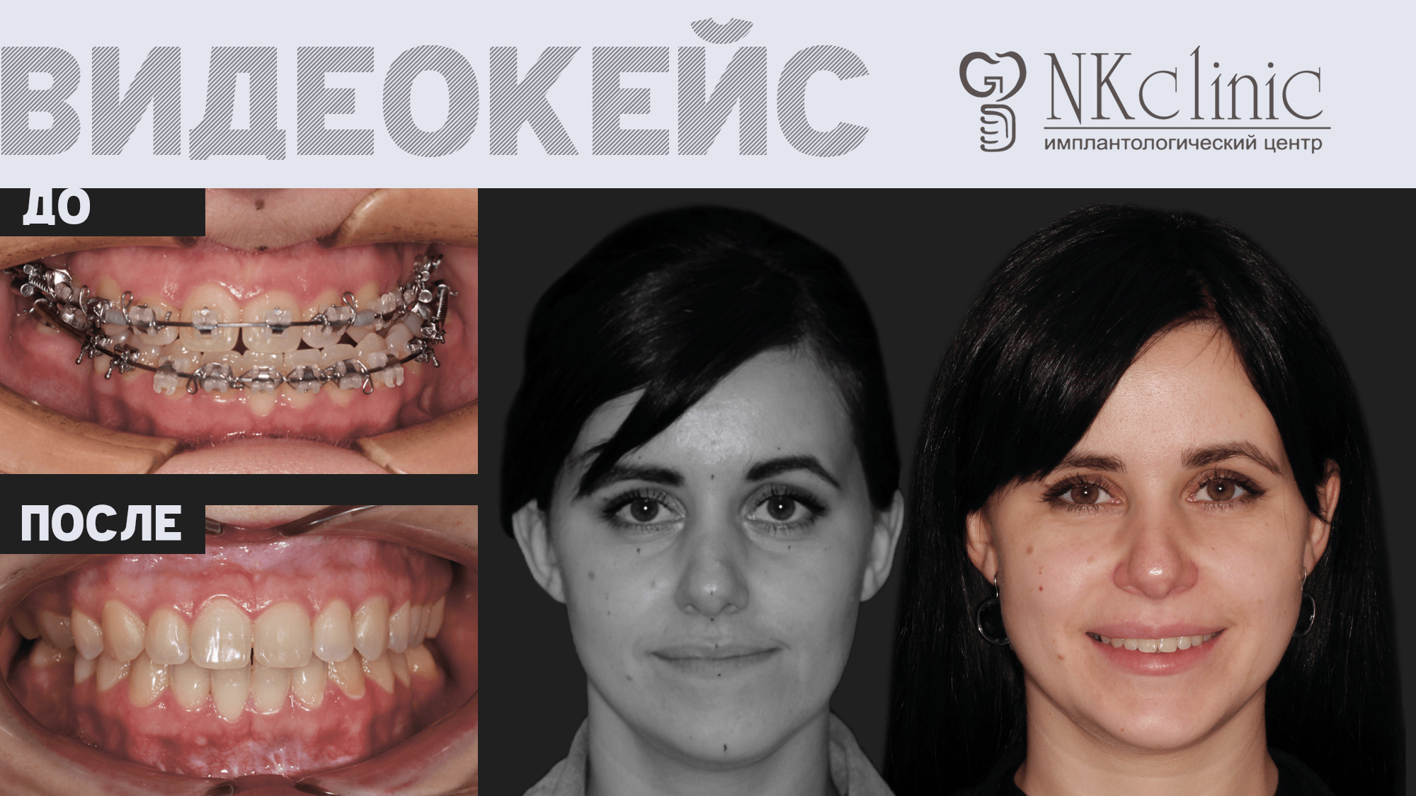 Асимметрия лица и аномалия прикуса. Клинический случай пациентки