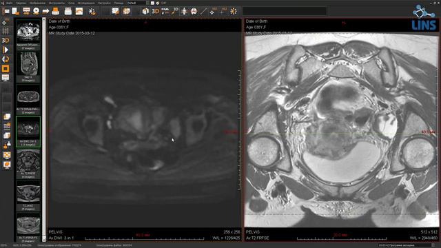 МРТ малого таза - наши ошибки. Ирина Трофименко