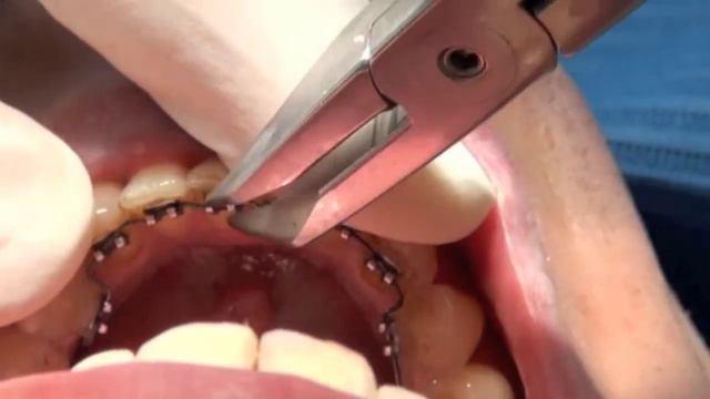 2D — открывание брекетов, Dr. Alexander Gebhardt