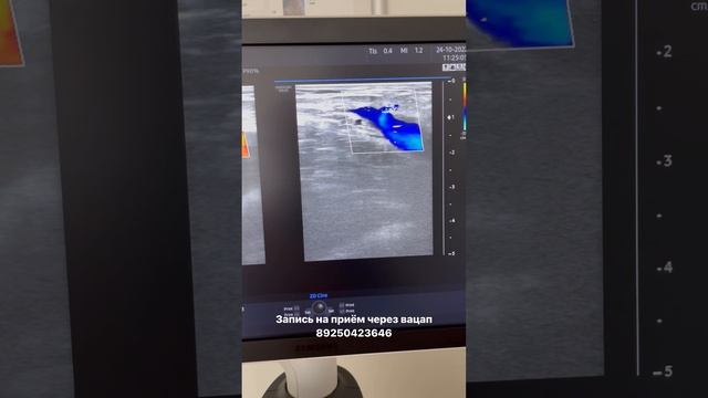 Варикоз на ноге у парня. Узи сосудов. Лечение варикоза. Флеболог. Флеболог Москва