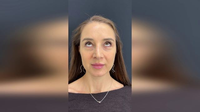 Осмотр через полтора года после пластики нижних век и операции Булхорн