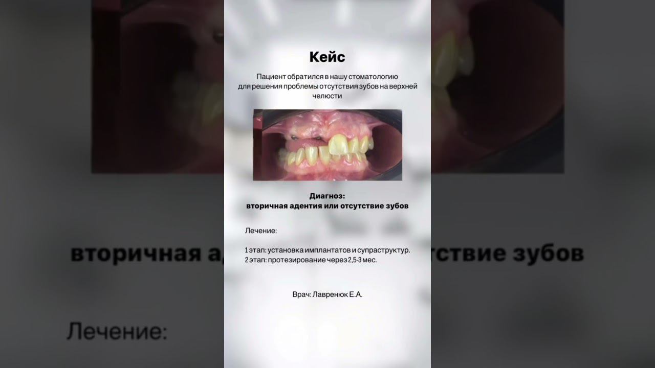 Имплантация кейс #shorts #стоматолог  #зубы