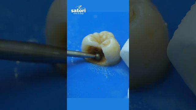 Препарирование кариозной полости