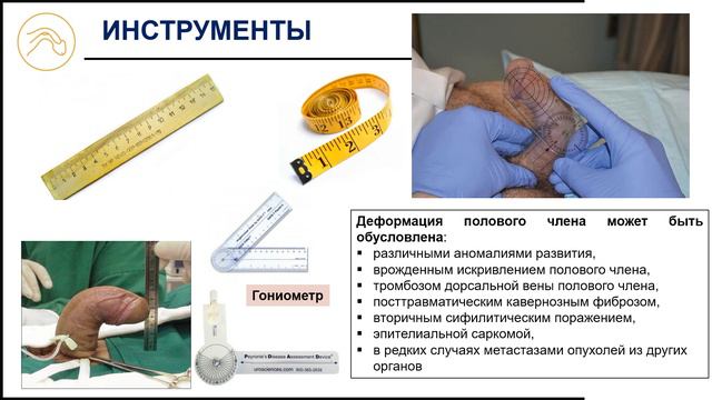 Видеолекция №5. Фибропластическая индурация полового члена