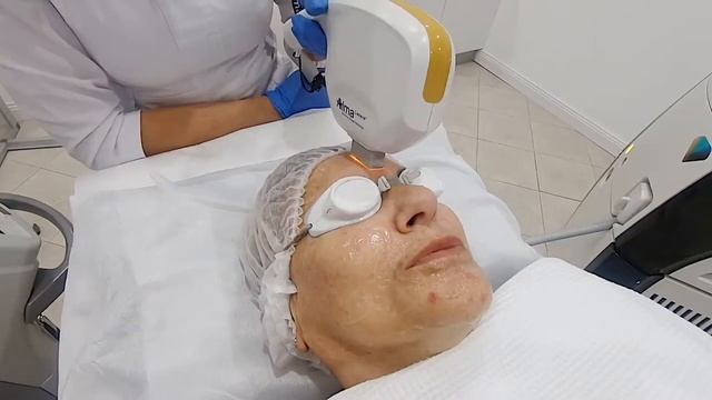 AFT ФОТООМОЛОЖЕНИЕ ЛИЦА HARMONY XL Сеть клиник косметологии GEN87