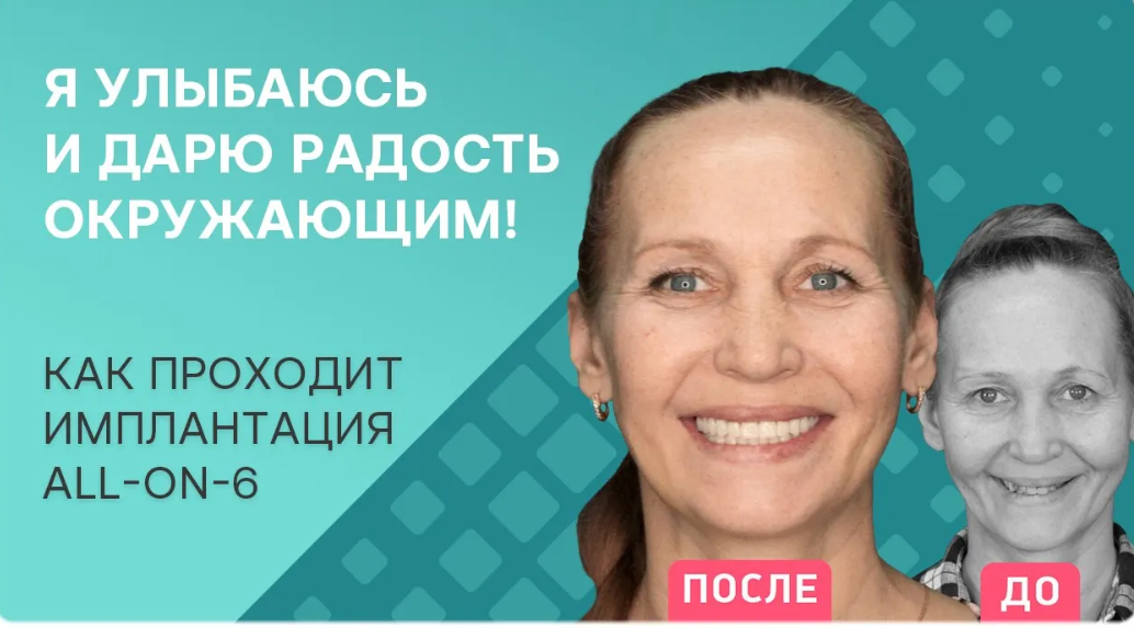 Все этапы имплантации all-on-6 ? отзыв и ощущения реального пациента