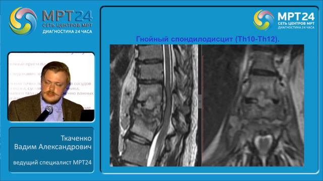 Воспалительные изменения костно-суставной системы на МРТ